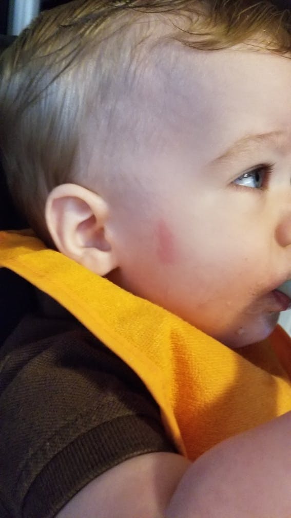 My son has this random red splotch on his face. - Winnie